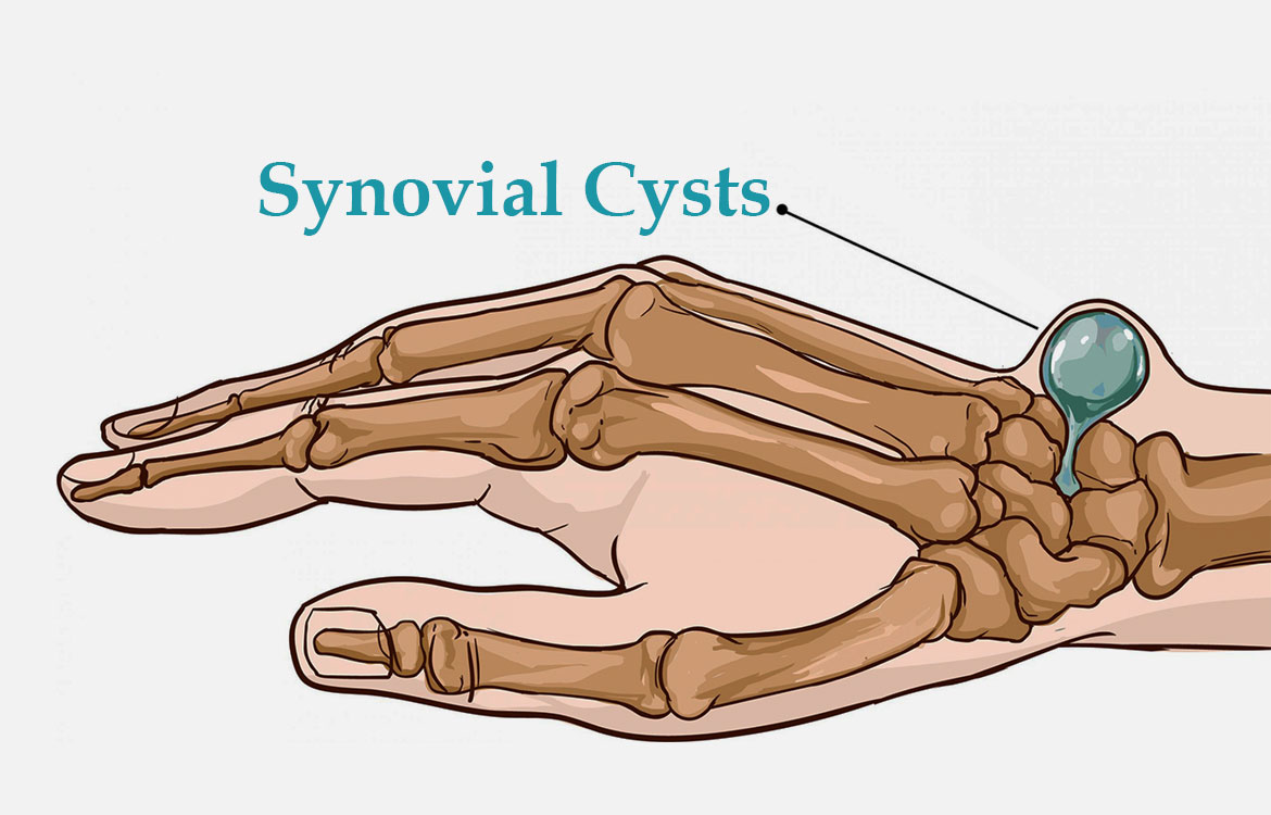 جراحات إزالة الأكياس الدهنية والزلالية - دكتور وائل شعلان